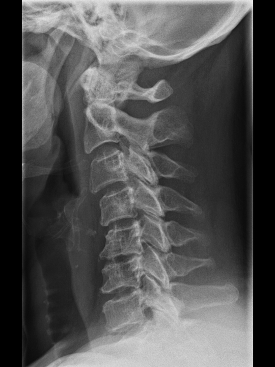 max-detection-max-dynamic-c-spine-lateral-clinical_3x4-01180871~8 ...